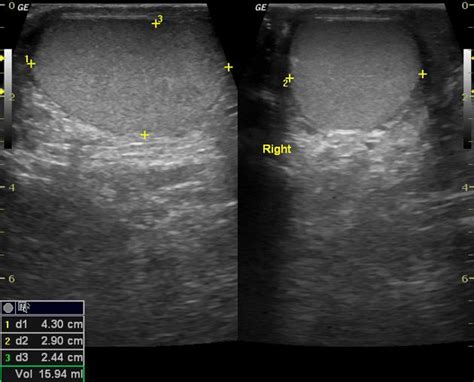 Orchitis Ultrasound
