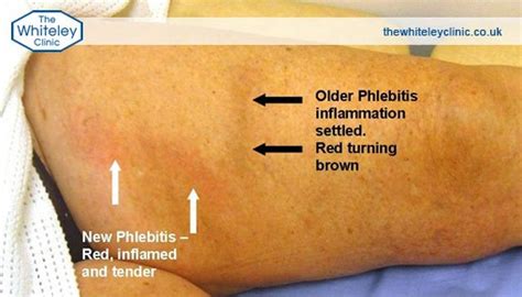 What Are The Signs And Symptoms Of Phlebitis