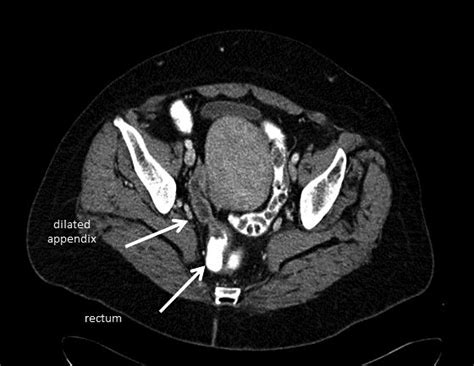 Preoperative Ct Scan Demonstrating A Dilated Appendix Abutting The