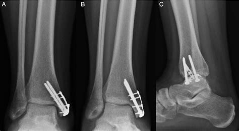 Medial Malleolus Tibia