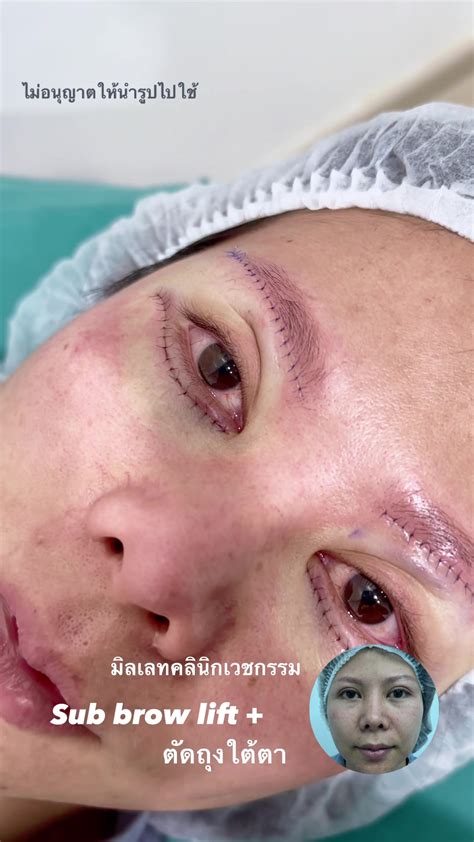 📌📌sub Brow Lift ตัดถุงใต้ตา หลังทำทันที ‼️ Millet Clinic ชื่อนี้มีแต่คำว่าสวย 🥰 🔸สนใจ