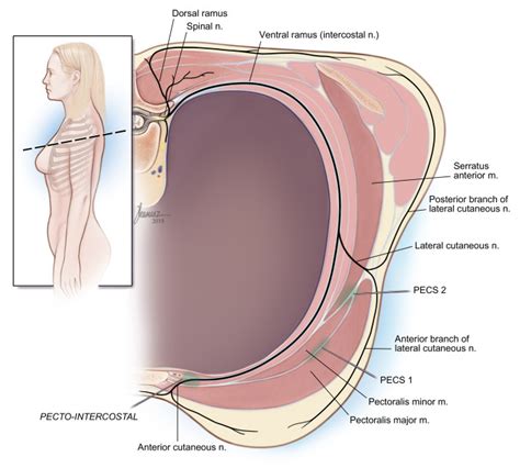 Pecs And Pecto Intercostal Blocks Anesthesia Key