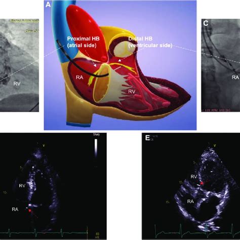 His Bundle Pacing Location A The Graphic Illustration Of The His