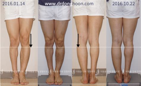 Shortening Of Bone 3cm Shortening For Treatment Of Leg Length