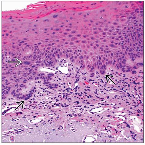 Actinic Cheilitis Histology