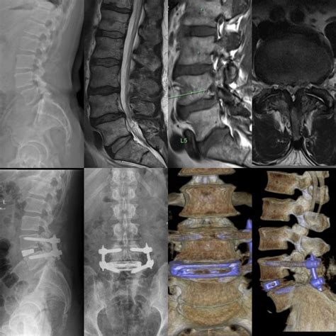 Mike Selby On Linkedin A Simple Prone Lateral Transpsoas Interbody Fusion And Perc Screws