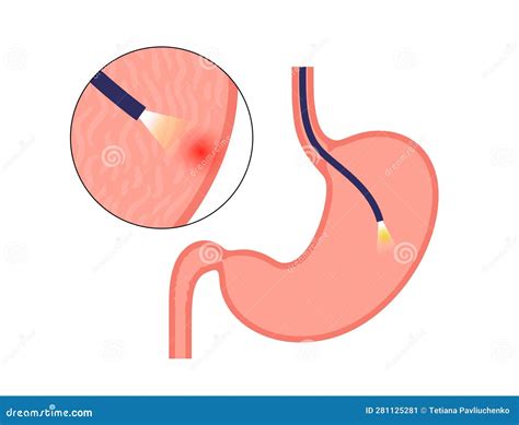 Gastroscopy Endoscopy Procedure Cartoon Vector