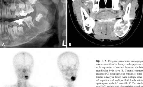 Aneurysmal Bone Cyst Jaw Aneurysmal Bone Cyst Jaw
