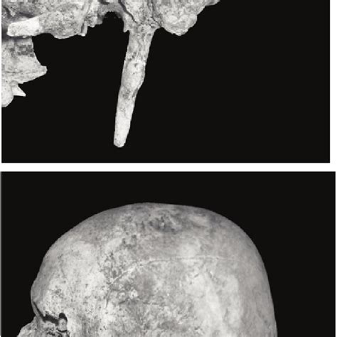 Oc 002 08 Left Styloid Process Note The Swelling At The Site Of