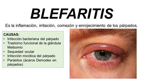 PÁRPADO BLEFARITIS Es la inflamación irritación comezón y