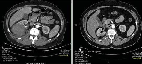 Ct Images From A 64 Year Old Patient Who Failed Percutaneous Download Scientific Diagram