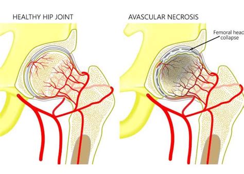 Core Decompression Hip Doctor Sugar Land Pearland Houston Tx