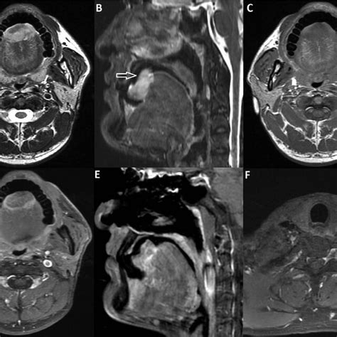 Magnetic Resonance Imaging A T2 Weighted Axial And B Short Ti