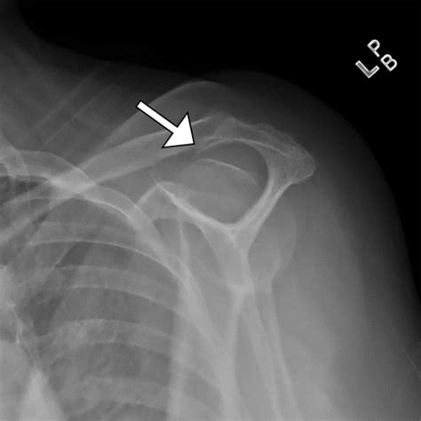 Coracoid Process X Ray