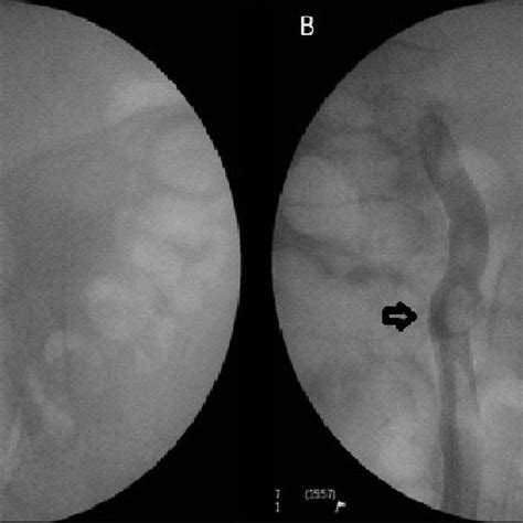 A Left Ureterogram Demonstrating Multiple Filling Defects Within The