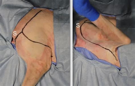 Step By Step Forelimb Amputation In A Dog Clinicians Brief