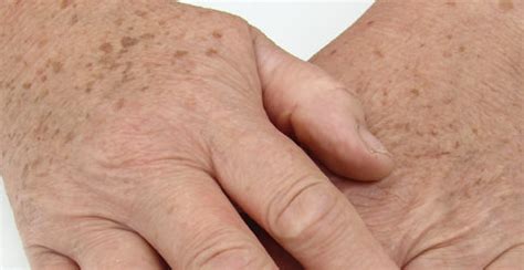 Barnacle Skin Cancer