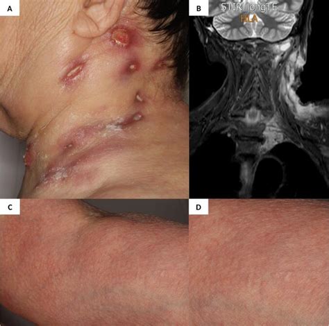 Scrofuloderma And Granuloma Annulare Like Lesions Challenges Of Diagnosing Cutaneous