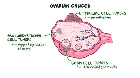 Ovarian Cancer Clinical Sciences Osmosis Video Library