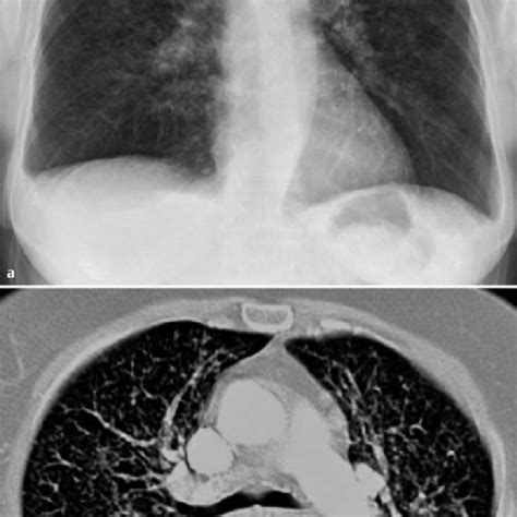 Pdf Bronchiolitis Part 1 Anatomic Features Classification