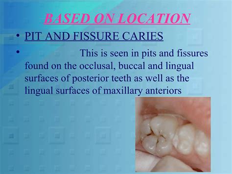 Aetiopathology And Classification Of Caries Ppt