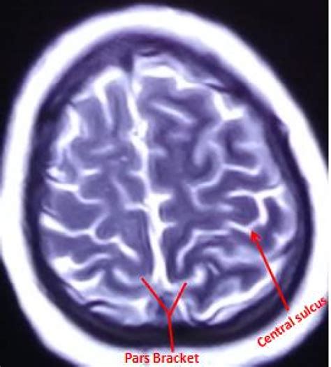 Figure 2 From Pars Marginalis And Pars Bracket Sign For Easy And Fast