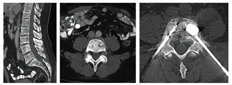 vertebral augmentation trimed spine and joint