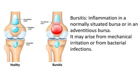 Calcaneal Spur And Chronic Bursitis Ppt