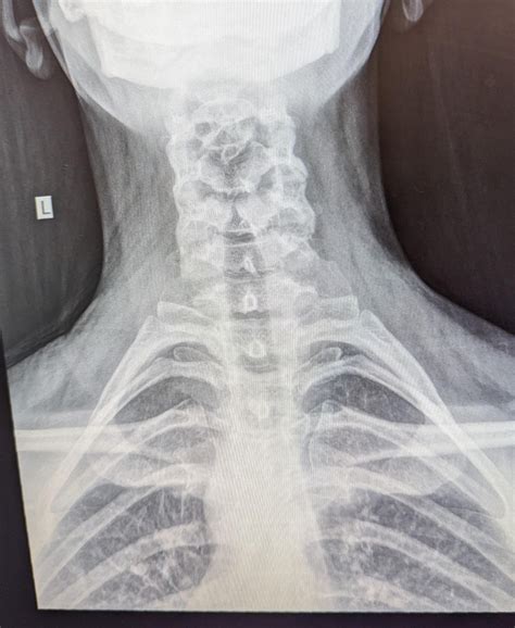 Cervical Ribs Ranatomy
