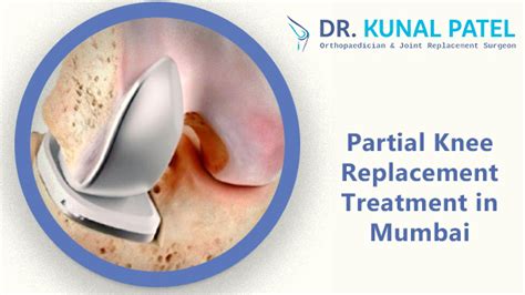 Partial Knee Replacement Treatment In Mumbai