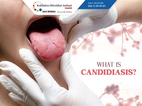 What Is Candidiasis What Is Candidiasis
