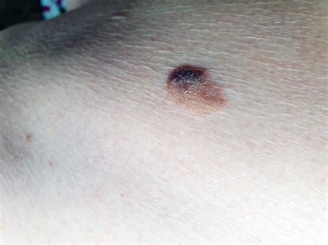 Seborrhoeic Keratosis Seborrhoea Wart Oscestop Osce Learning