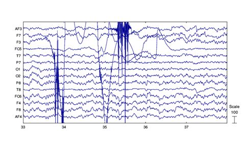 Significant Interference Affects The Lower Eeg Signal Recorded On Download Scientific Diagram