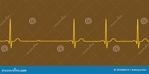 An Ecg With 2nd Degree Mobitz 2 Av Block 3d Illustration Stock