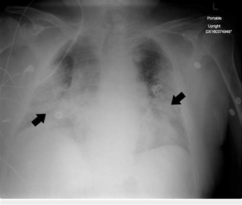 Chest Radiograph 48 H Following Hospital Admission Showing Worsening