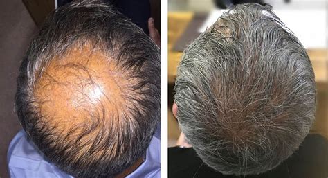 Mhr Clinic Uk Hair Transplants In Manchester And Harrogate
