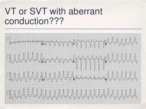 Advanced Ecgs