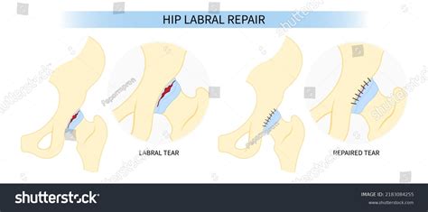 Hip Labrum Tear Over 32 Royalty Free Licensable Stock Vectors And Vector