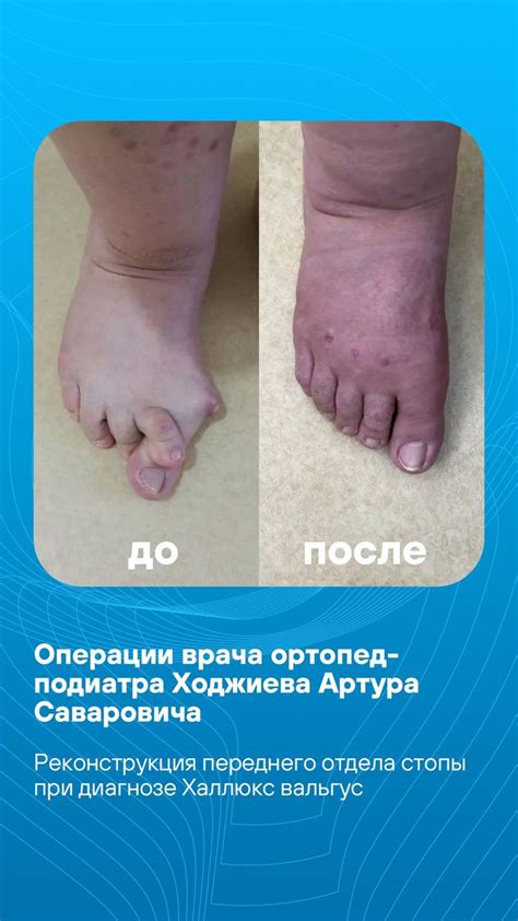Халюс вальгус причины симптомы и лечение