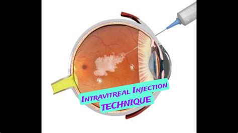 Intravitreal Injection