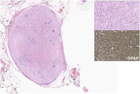 A Neuroglial Neoplasm In Retroperitoneal Lymph Nodes Metastasis From A