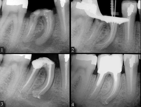 A Comparison Of Two Carrier Based Obturators Thermafil And Guttacore Endodontic Practice Us