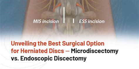 The Bets Surgery For Herniated Discs Micro Vs Endo