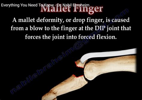 Mallet Finger —