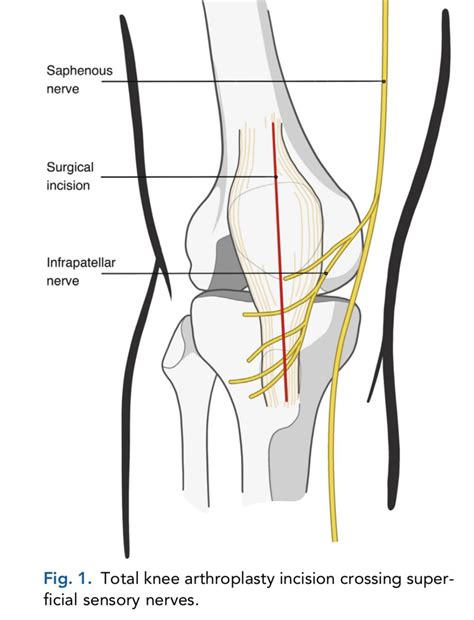 Pinched Nerve In Knee Causes Treatment Recovery And More Artofit