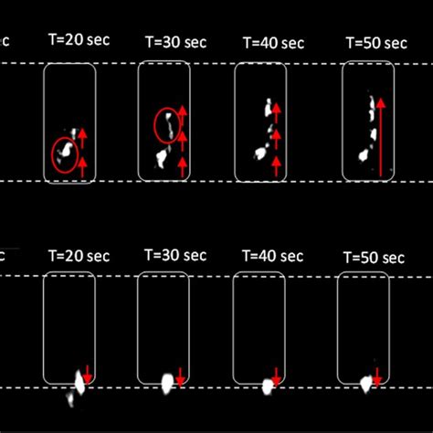Bolus Reflux On 60 S Nuclear Scintigraphy Esophageal Swallow Study