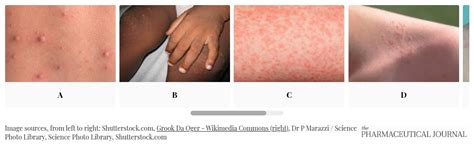 Test Your Knowledge Of Dermatological Conditions The Pharmaceutical