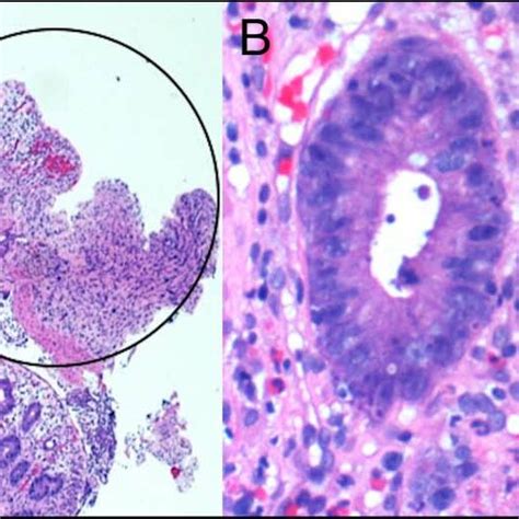 A Severe Cryptitis With Ulceration And Crypt Dropout Circle And Download Scientific