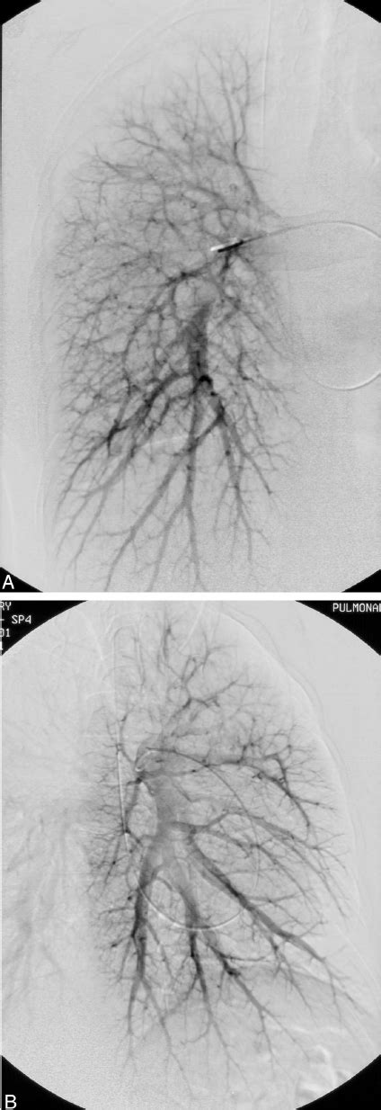 A Right Pulmonary Angiogram B Left Pulmonary Angiogram Download