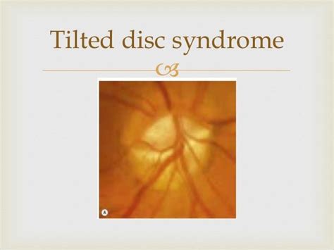 Optic Nerve Head Evaluation In Glaucoma